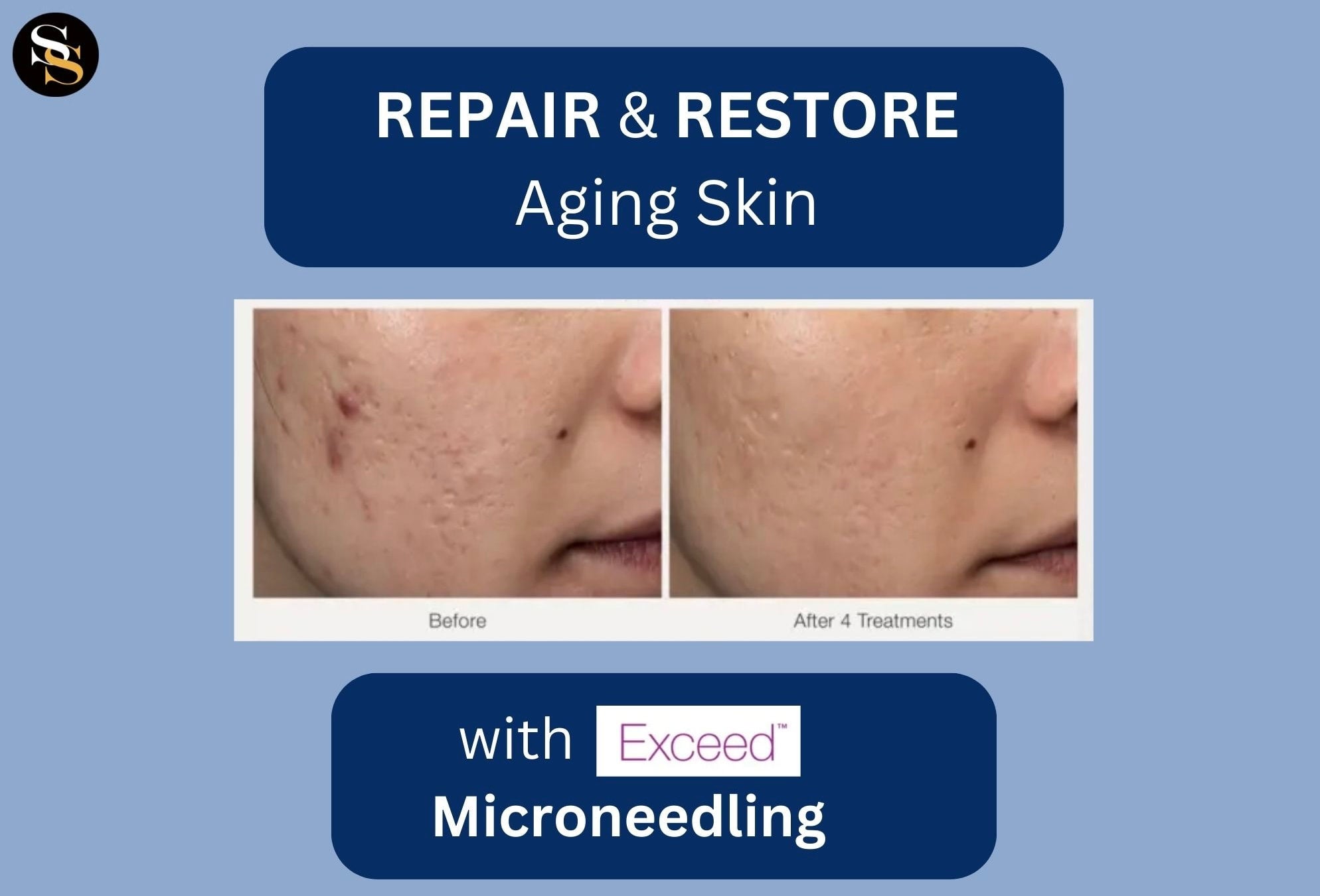Medical Micro needling (Exceed) 3 Treatment Package | Smooth Solutions ...